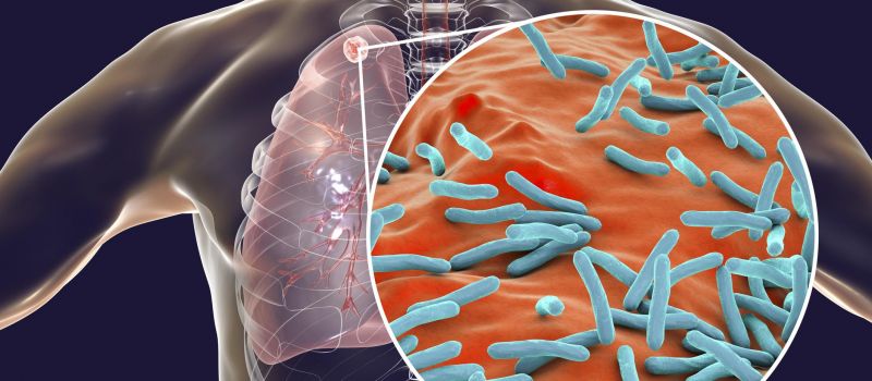 Tuberculosis and its origins